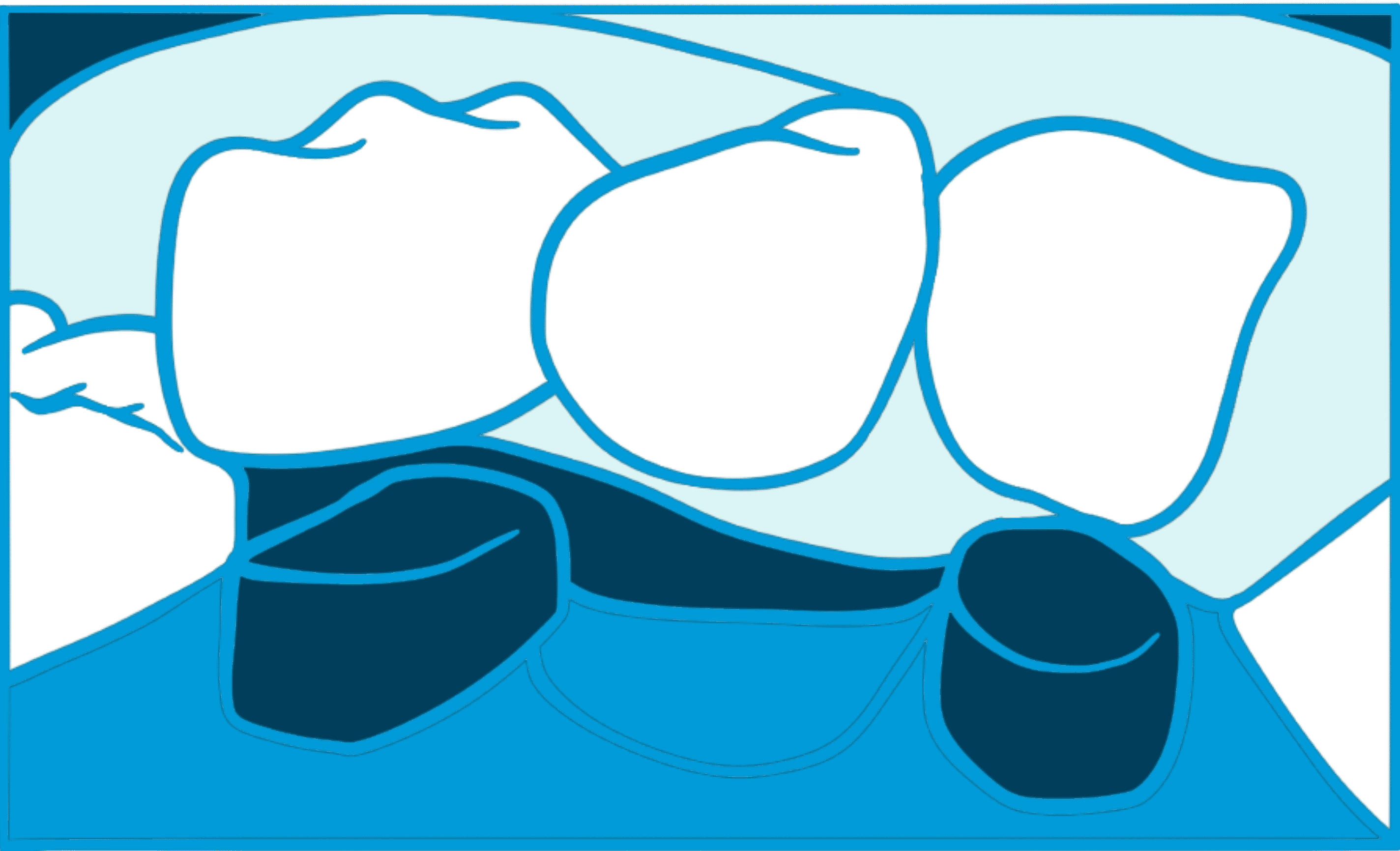 The Importance of Replacing Missing Teeth: Why It Matters for Your Oral ...